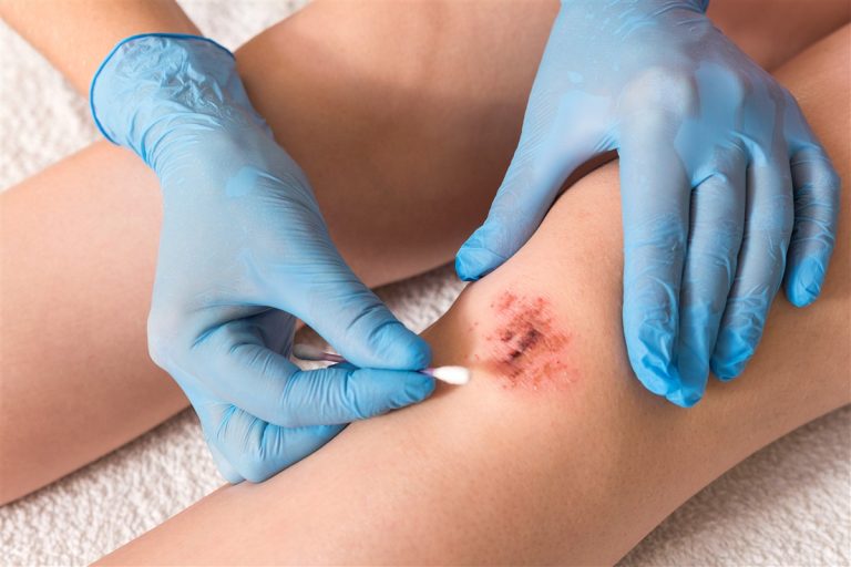 Comment faire mûrir un furoncle pour le percer